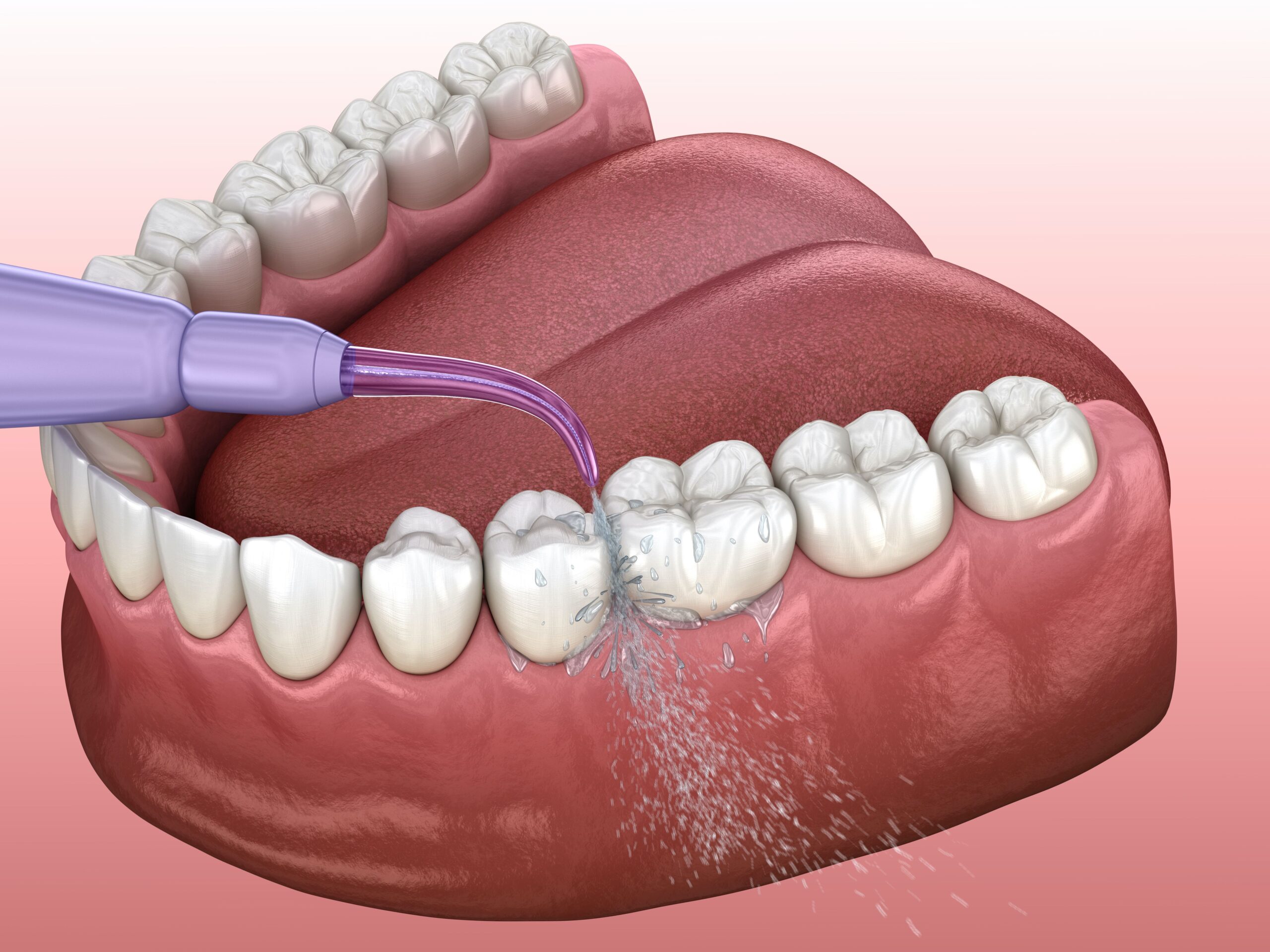 Do Dentists Recommend Ultrasonic Tooth Cleaners? | Comprehensive Guide